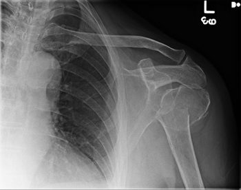 Proximal Humerus Fractures - Yorkshire Shoulder Clinic