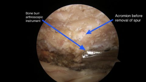 Shoulder Impingement - Yorkshire Shoulder Clinic