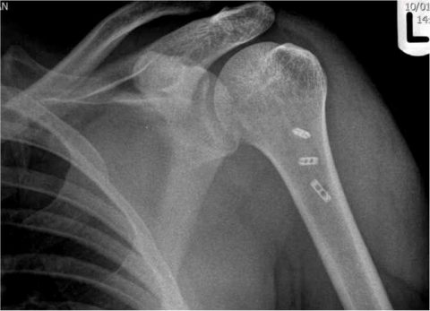 Pec Major Ruptures - Yorkshire Shoulder Clinic