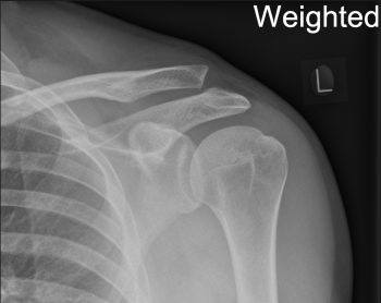 Acromioclavicular Joint Injuries (ACJ) - Yorkshire Shoulder Clinic