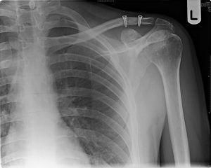 Acromioclavicular Joint Injuries (ACJ) - Yorkshire Shoulder Clinic